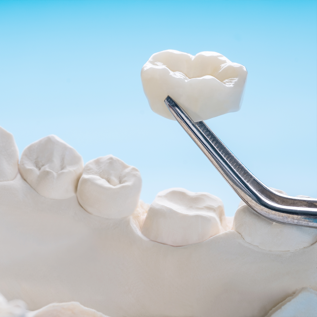 Porcelain Crowns • The Tooth Place